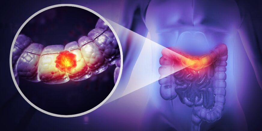 A Core Cancer Therapy Is Being Ignored: Research Shows Fasting Exploits ...